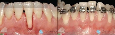 Periodontal Plastic Surgery Associated With Orthodontic Movement For