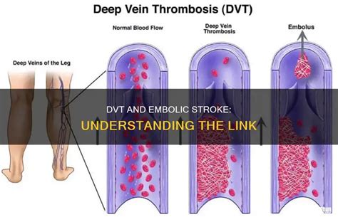 Dvt And Embolic Stroke Understanding The Link Medshun