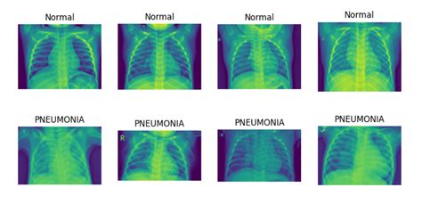 Github Nikishsubedipneumoniaclassification Classification Of Pneumonia Using Tensor Flow