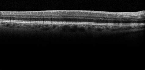 Oct Segmentation Roboflow Universe
