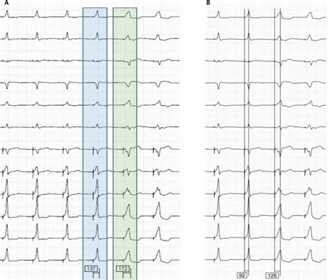 His Bundle Pacing And Left Bundle Branch Area Pacing Feasibility And Safety Revista