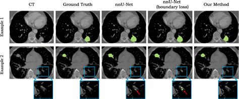 3d Lung Tumour Segmentation Comparison Between Our Method And Nnu Net