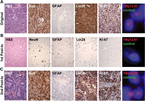 Pathology Specimens Of Patient 2 A Original Resection Specimen Download Scientific Diagram