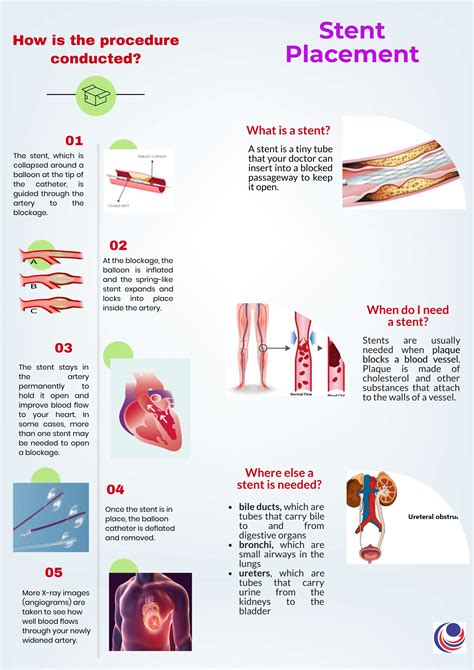Stent Placement Process And Post Operative Care Niruja HealthTech