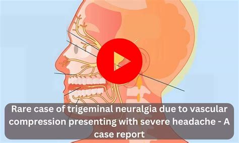 Rare Case Of Trigeminal Neuralgia Due To Vascular Compression Presenting With Severe Headache