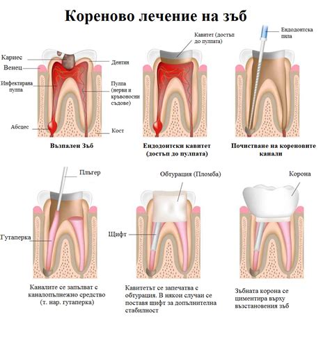 Кореново лечение на зъб