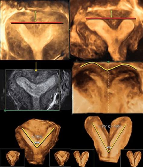 How Rare Is Septate Uterus