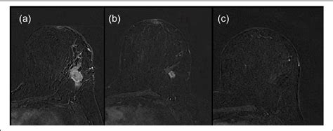Figure 1 From Magnetic Resonance Imaging Tumor Regression Shrinkage Patterns After Neoadjuvant