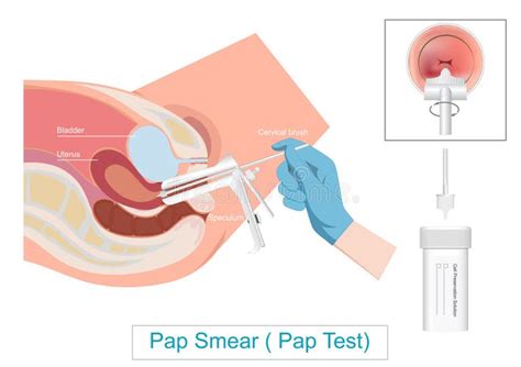 Pap Test Pap Smear Cervical Cancer Screening Stock Vector Illustration Of Brush Disorder