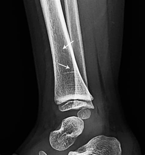 Its Tough Being A Kid Babes Fracture Radiology Key