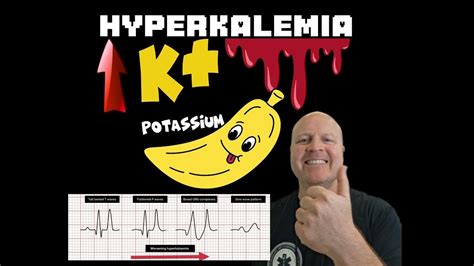 Why Hyperkalemia Causes A Widened Qrs Complex On The Ecg Explained
