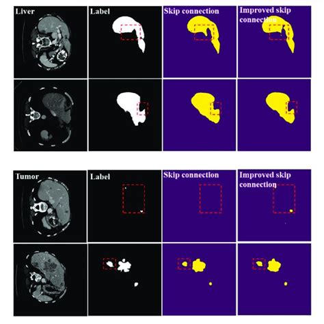 Segmentation Results Of General Skip Connection And Improved Skip Download Scientific Diagram