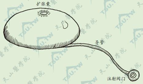 附图 皮肤软组织扩张器简介 皮肤病学 天山医学院