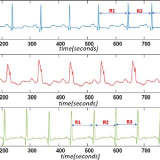 PDF Classification Of ECG Signals Using Deep Neural Networks