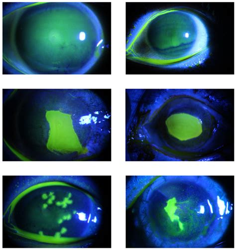Detection Of Corneal Ulcer Using A Genetic Algorithm Based Image Selection And Residual Neural