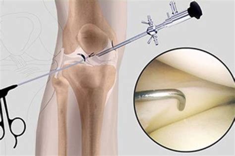 Acl Pcl Reconstruction Shashidhar Orhopedic
