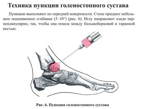 Методики пункции суставов презентация онлайн