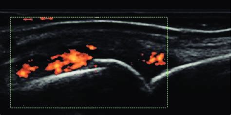 Dorsal Longitudinal Scan Of The Second Metacarpophalangeal Joint Mcp