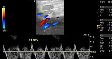 Ultrasound Imaging Pulsatile Flow In Veins