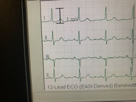 T Wave Inversions And Biphasic P Waves R Askcardiology
