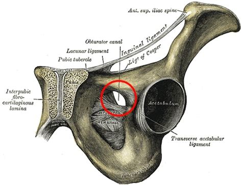 Obturator Hernia The Operative Review Of Surgery