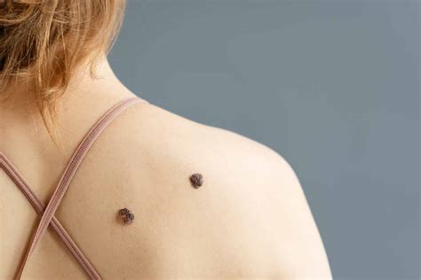 Melanoma Cáncer De Piel Oncología Msd Spain