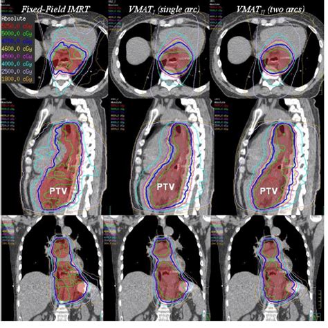 Dose Distribution Comparison Between The Imrt Left Vmat I Single Arc