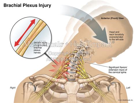 Brachial Plexus Injury