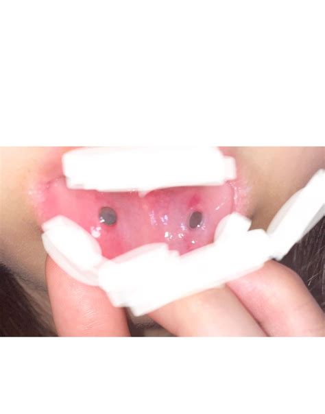 입술피어싱 뚫음 질문 지식in