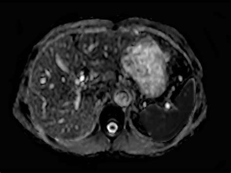 Free Breathing Abdominal Imaging Philips Mr Body Map