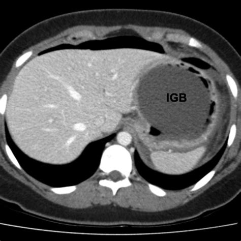 Ct Scan Demonstrating Left Subphrenic Abscess With Destruction Of The