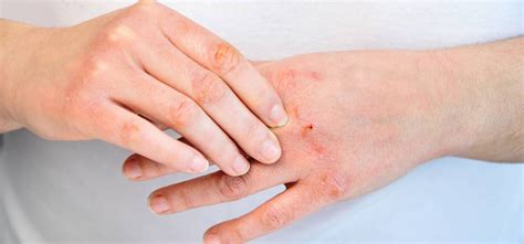 How To Protect Your Workforce From Contact Dermatitis