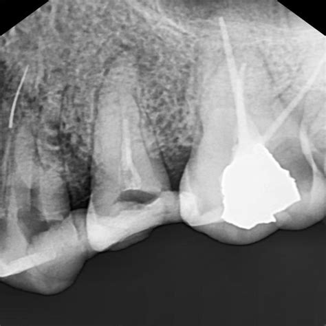 Dental Caries Classification Classification Model By Dental Caries