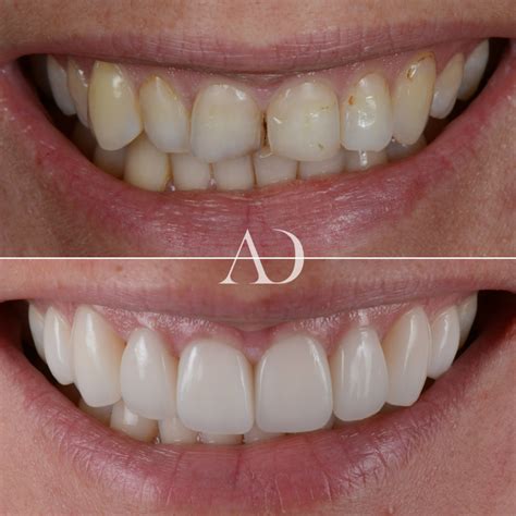 Dental Bridges Adore Dental