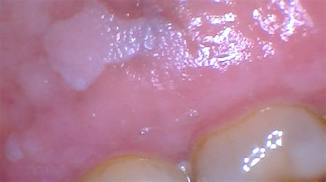 White Bumps On Gums