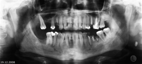 Desmodontite Apicale