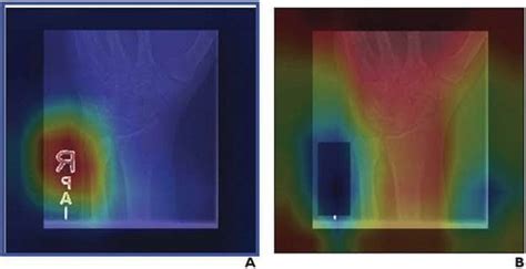Deep Learning For Extremity Radiographs Confounded By Labels Axis Imaging News