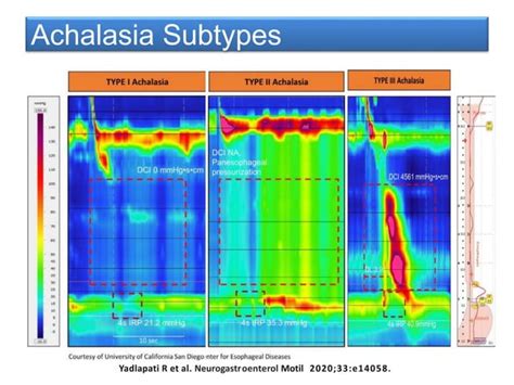 Chicago Classification Version 40 Hrm Classification Of Esophageal Motility Disorder