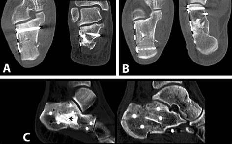 Open Reduction Internal Fixation Using An Extensile Lateral Approach For A Joint Depression