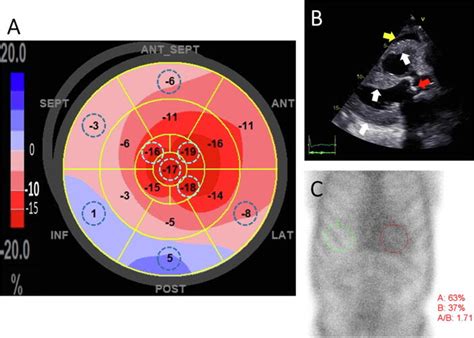 Prognostic Assessment Of Relative Apical Sparing Pattern Of