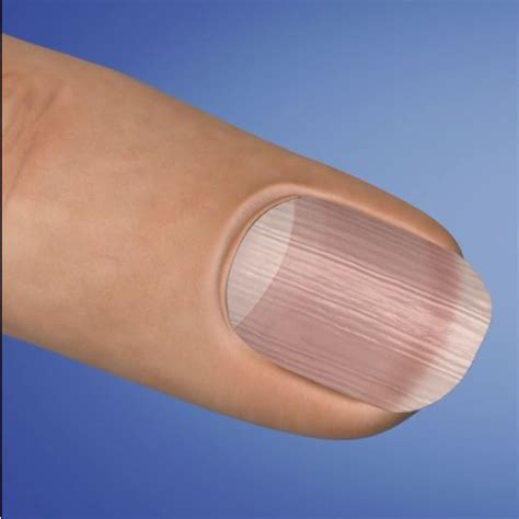 Understanding Onychorrhexis And Its Impact On Nail Health Nailknowledge