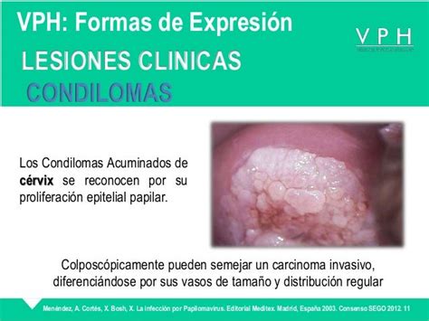 Vph Virus Del Papiloma Humano
