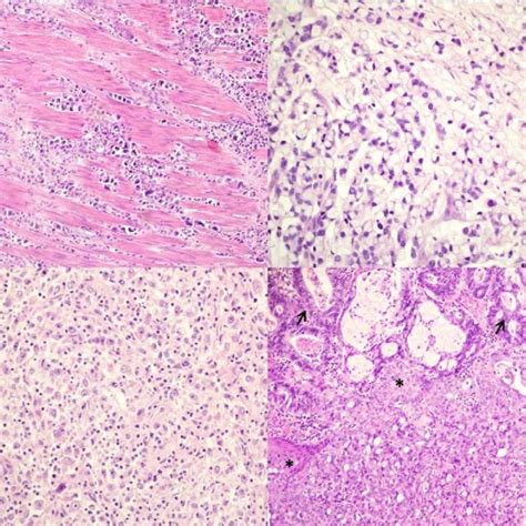 Schematic Representation Of The Siewert Macroscopic Classification Of Download Scientific
