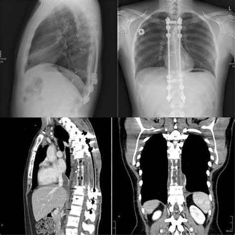 Thoracic Corpectomy For Neoplastic Vertebral Bodies Using A Navigated Lateral Extracavitary
