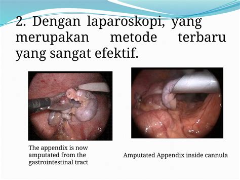 358244401 Power Point Apendiksitispptx H Pptx