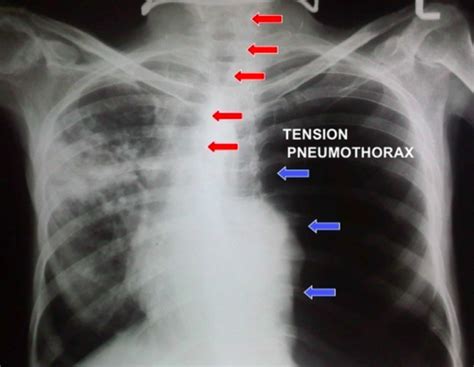 1 Ards Practice Questions Flashcards Quizlet
