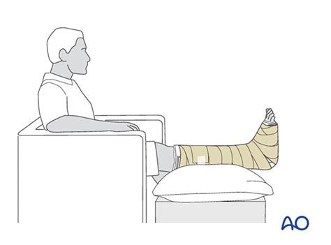 Primary Fusion Of Unreconstructable Calcaneocuboid Joint
