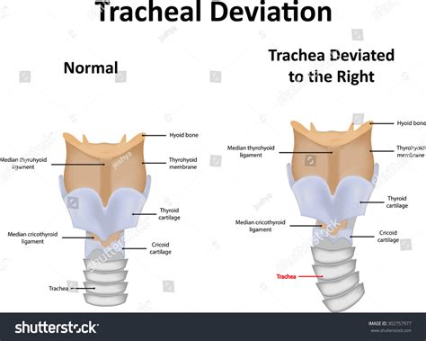 7 Imágenes Fotos De Stock Objetos En 3d Y Vectores Sobre Tracheal