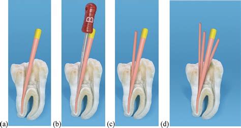 Clinical Steps Of Cold Lateral Compaction Technique Using Master And Download Scientific