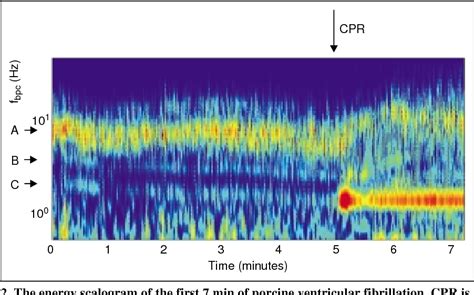 Figure 2 From Evaluating Arrhythmias In Ecg Signals Using Wavelet Transforms Semantic Scholar